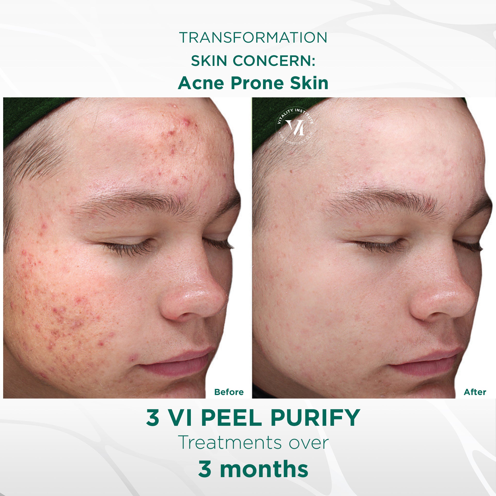 VI Peel Purify Professional Treatment – VI Derm